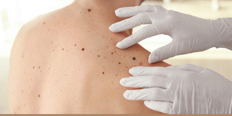 Is it Safe to Remove Moles with Apple Cider Vinegar? | BSI