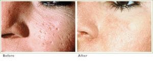 Acne Treatment Dermatologist - Berman Skin Institute
