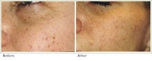 Acne Treatment Dermatologist - Berman Skin Institute