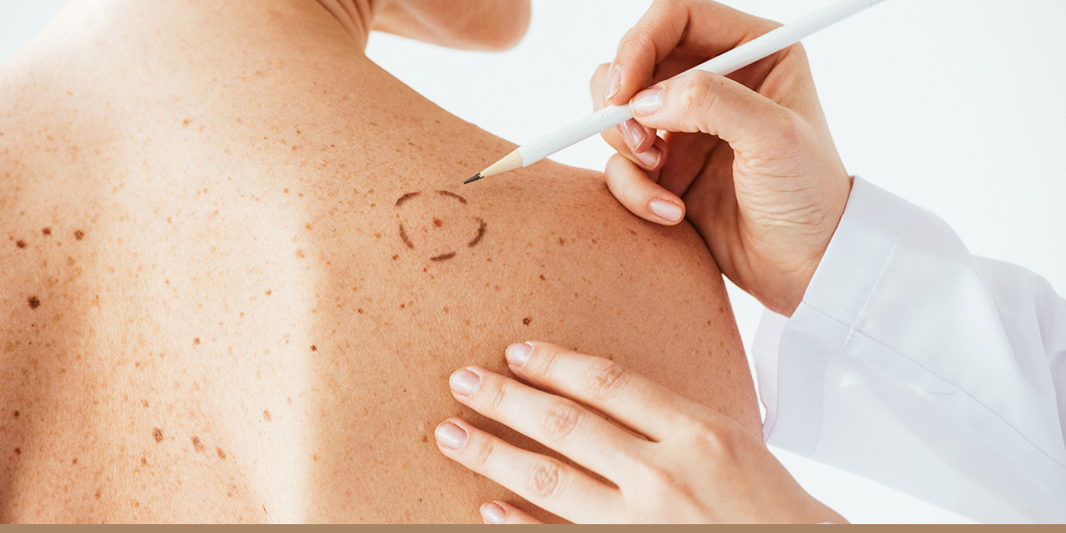 Skin Cancer Treatments Explained: What is Mohs Surgery?
